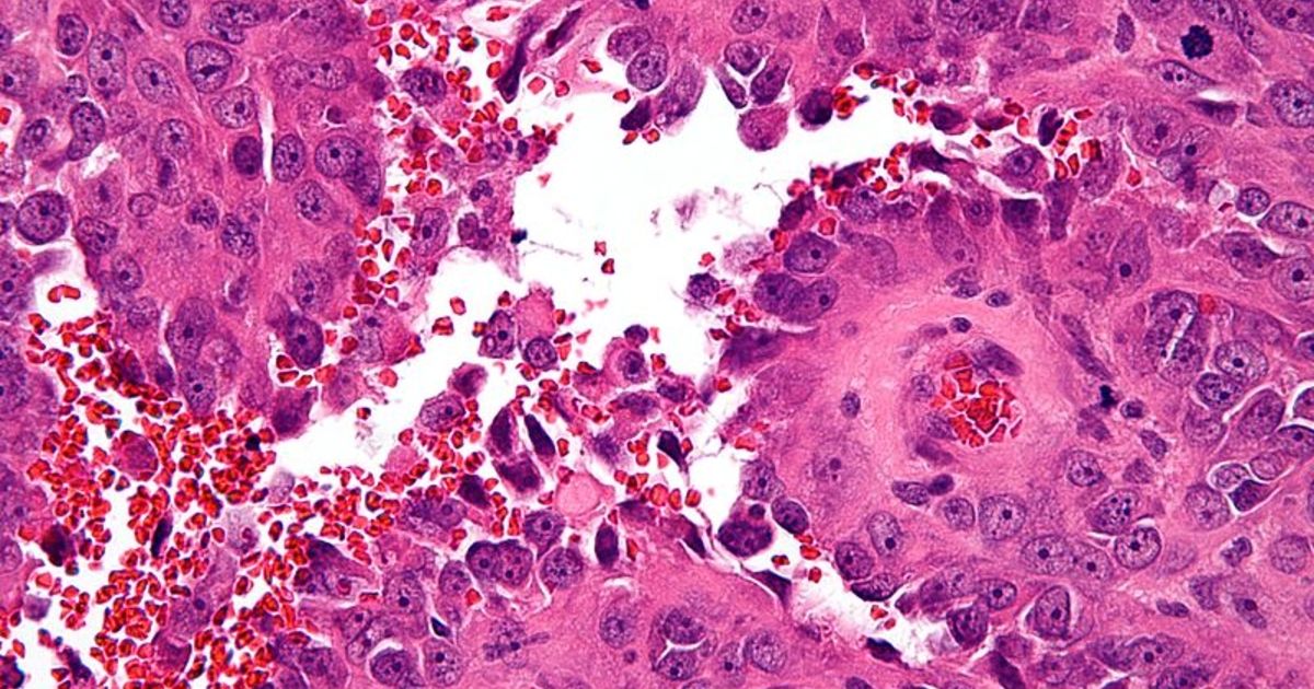 Angiosarcoma Research, Drug Trials Get Boost From Grassroots Effort ...