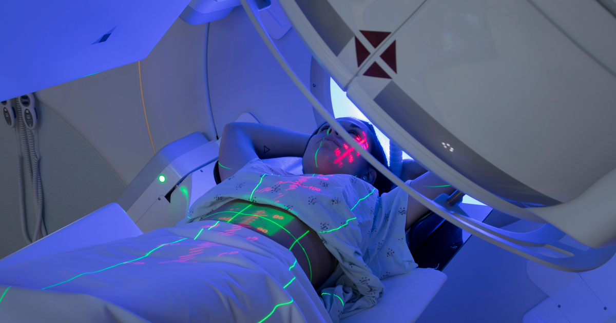 Exact Sciences Takes Aim at Radiotherapy Response Prediction With New ...