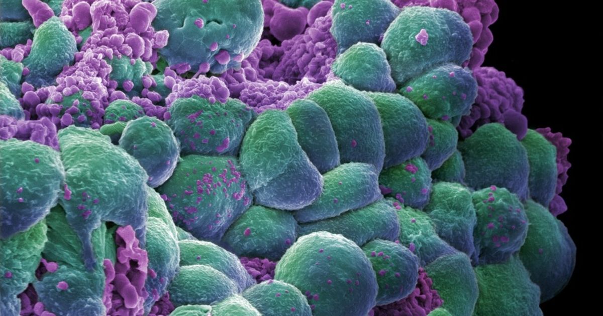 ESMO Trial Results Raise Possibility of Neoadjuvant Keytruda Use in ...