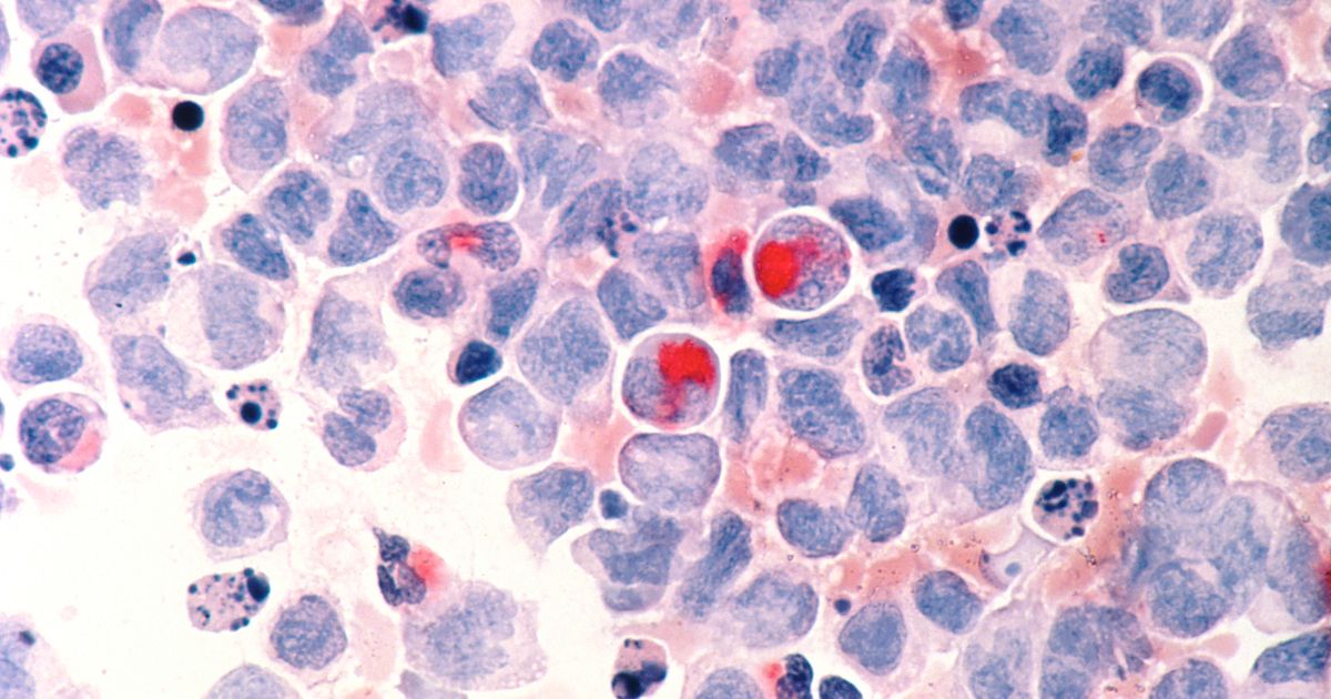 Arog Pharma Moving FLT3 Inhibitor Crenolanib Into Head-to-Head AML ...