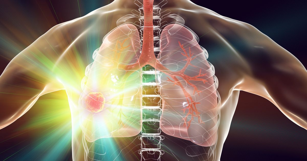 BMS Combo Drug Opdualag Effective in Neoadjuvant NSCLC, But Maybe No ...