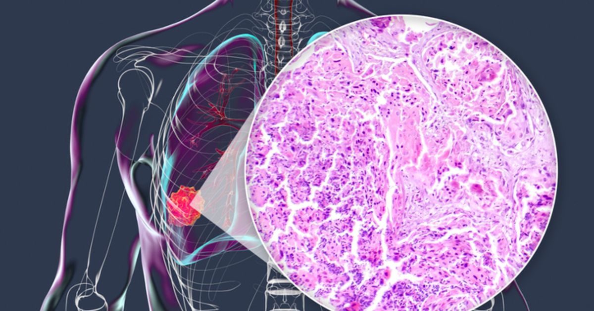 AstraZeneca Partners With Lunit to Develop AI-Driven Biomarker ...