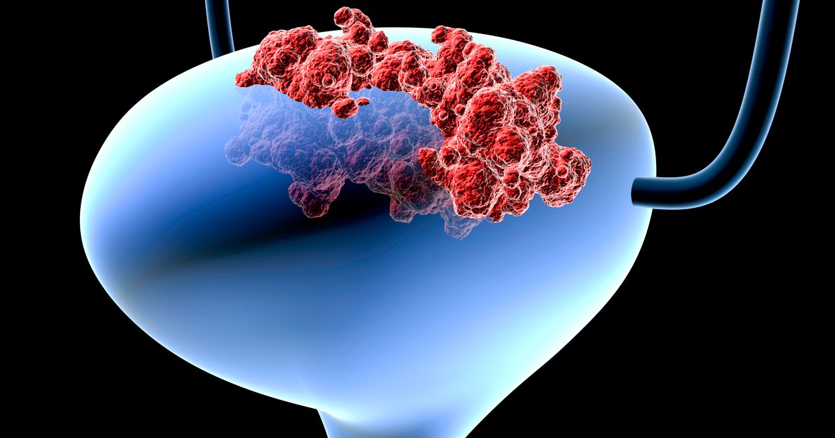 Bladder Cancer Genomic Landscape Study Aims to Engender New Biomarker ...