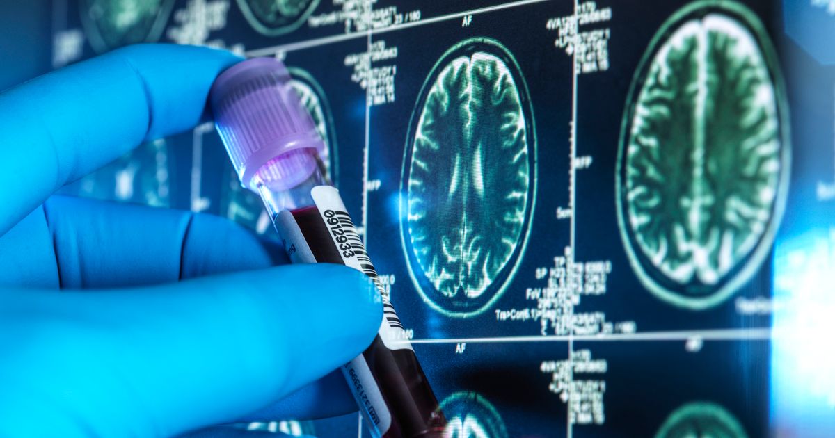 Blood-Based Tests for Alzheimer's Biomarkers Tau, Beta-Amyloid Prove ...
