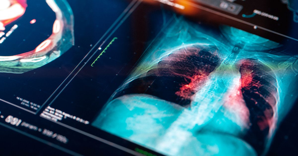 Gilead Sciences, Arcus Biosciences Tout Domvanalimab NSCLC Data as Good ...